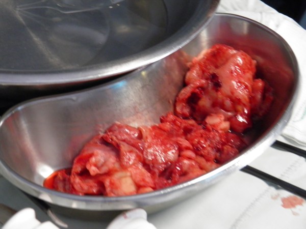 VATS decortication: Empyema – Thoracic Surgery