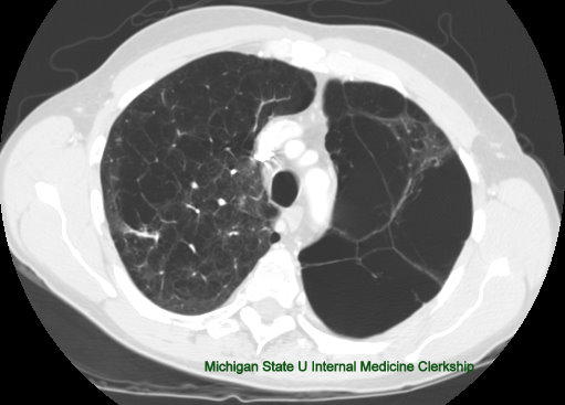 bleb resection – Thoracic Surgery