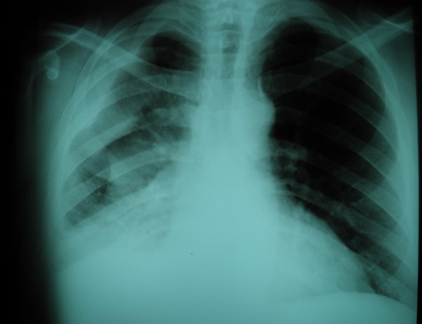 Case Report: Dual port thoracoscopy for decortication, part II ...