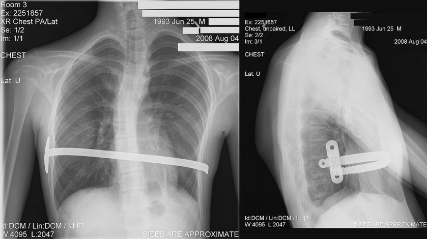 Chest Wall surgery – Thoracic Surgery