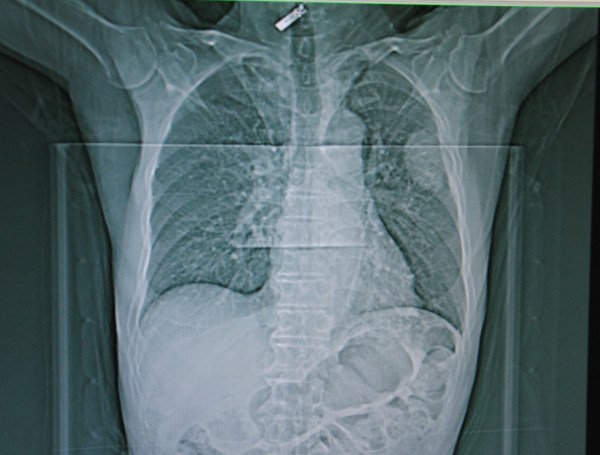 Uniportal VATS with chest wall resection – Thoracic Surgery