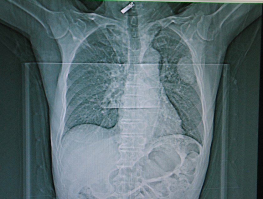 Uniportal VATS with chest wall resection – Thoracic Surgery