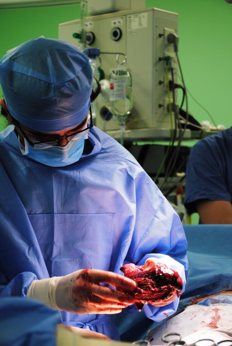 Uniportal VATS with chest wall resection – Thoracic Surgery