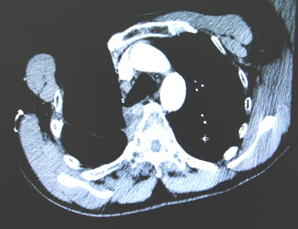 Bronchopleural Fistula: a classic example of interdisciplinary surgery ...