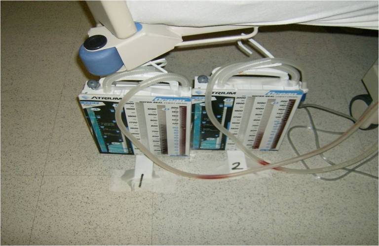 Developments in chest tube management – Thoracic Surgery