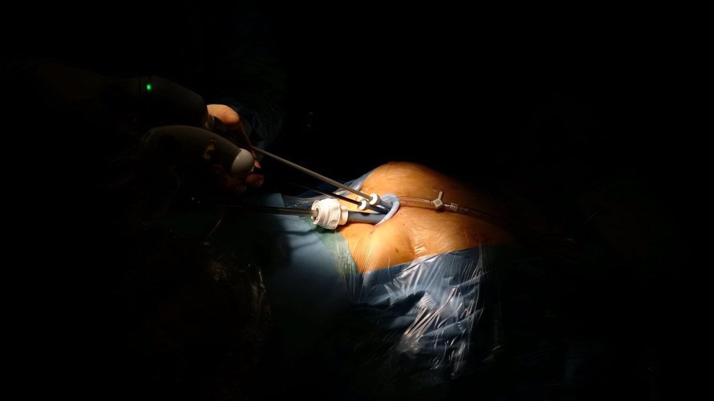 subxyphoid approach – Thoracic Surgery